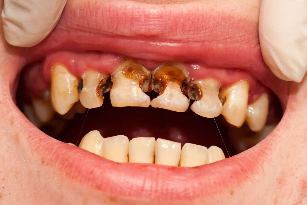 Tooth Cavity Filling and Cracked Tooth Filling: Your Comprehensive ...